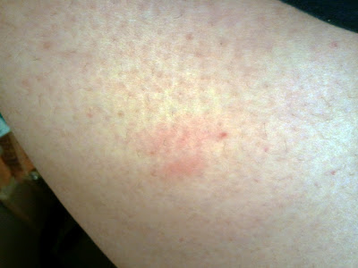 Copaxone Reactions: The Good, The Bad and the Ugly: How I do it