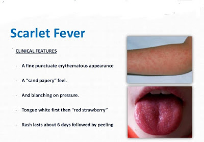 Pediatrics Notes: Clinical Features of Scarlet Fever