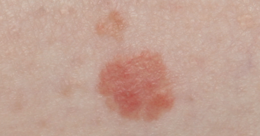 cancer genome: Skin Cancer - Types, Risks, Symptoms And Treatment