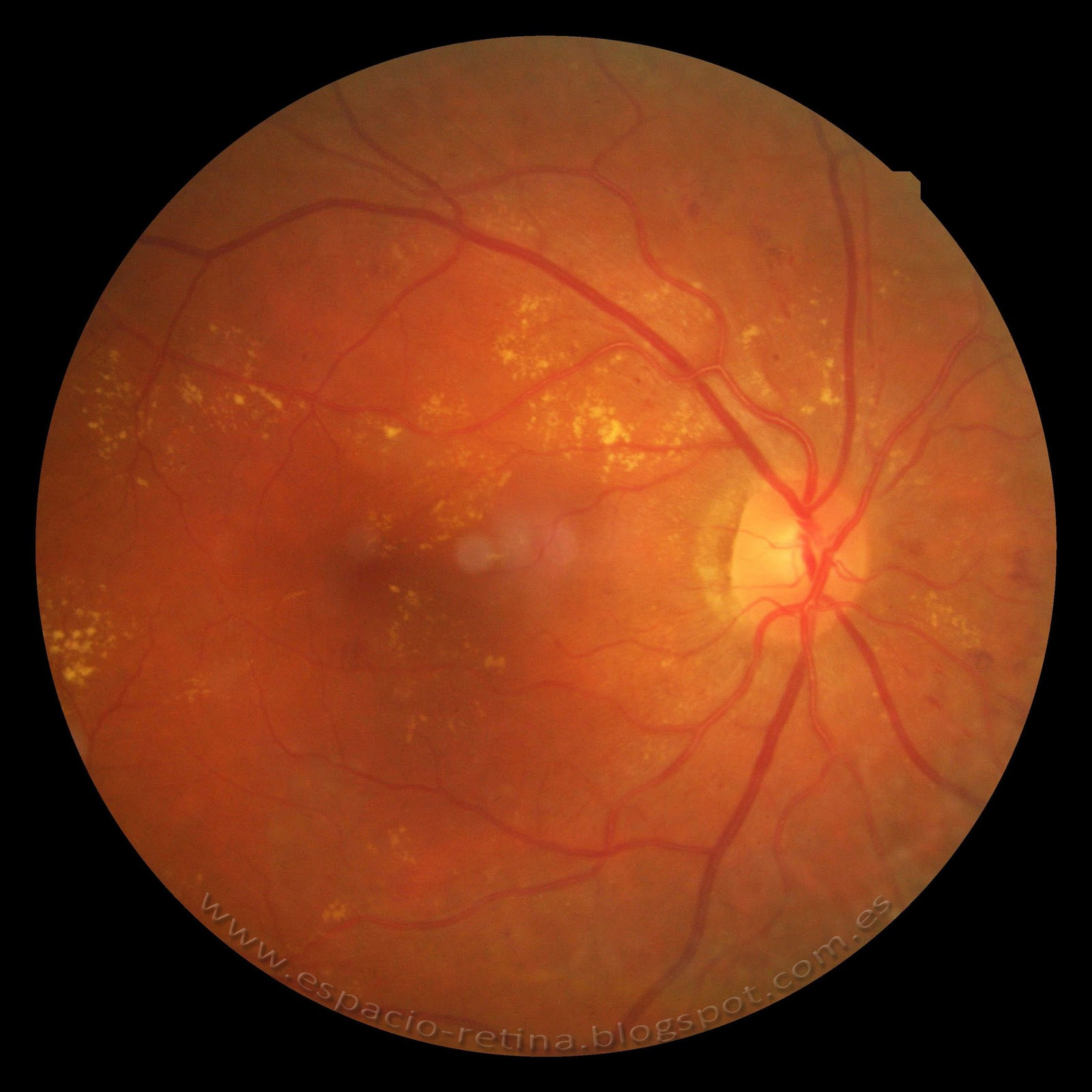 ESPACIO RETINA: Retinopatía diabética.