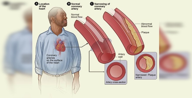 Cara Mudah Untuk Mengetahui Jantung Anda BERMASALAH ATAU TIDAK Yang ...