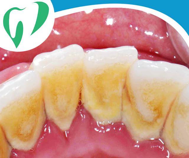 Dra. Karine Quintão: O que é tártaro?