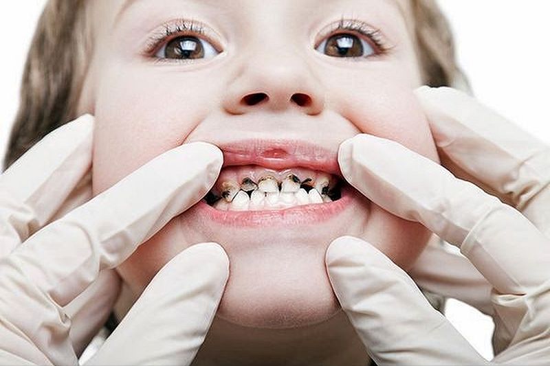 TOOTH DECAY is the biggest cause of primary school children being ...