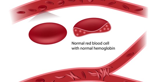 Sickle Cell Association Advocates Compulsory Genotype Test For Couples ...