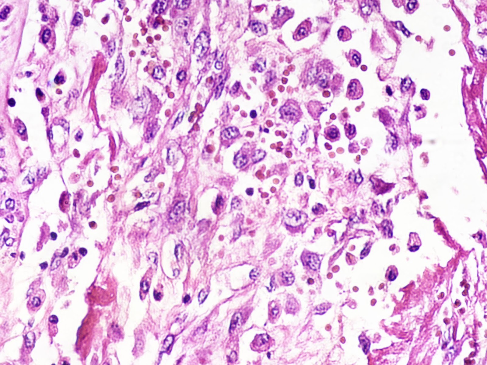 into the roots: Pericarditis