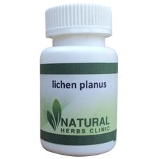 Lichen Planus Definition: Types and Treatment Technique