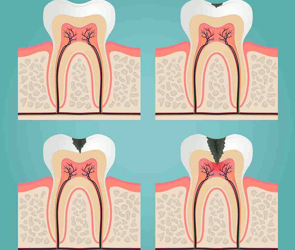 Terapia Pulpar para los dientes primarios: Enfoque Actual - OdontoVida