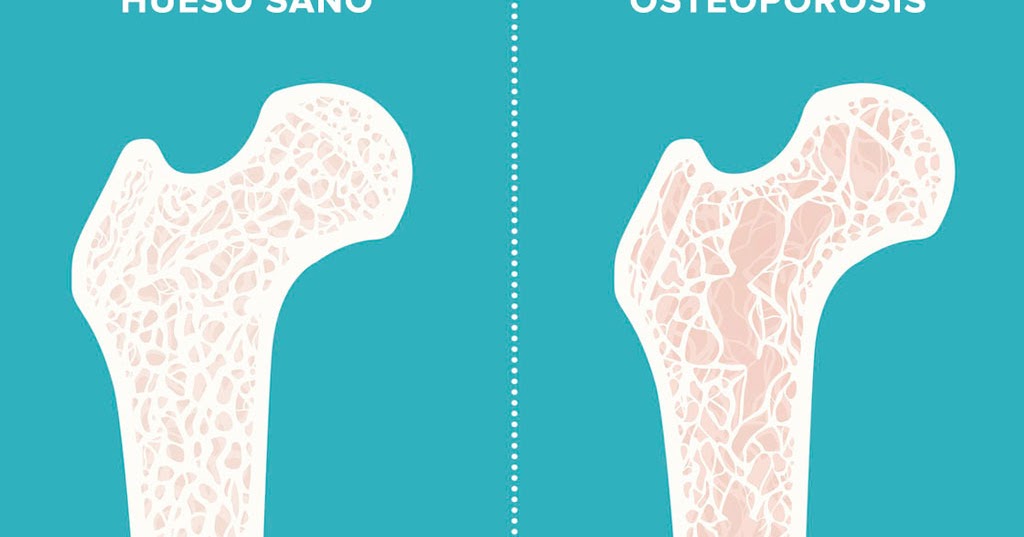 Osteoporosis: ¿QUE ES?