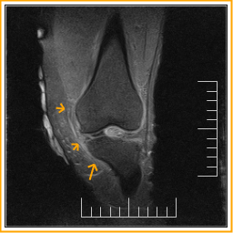O'Donoghue's unhappy triad -MRI - Sumer's Radiology Blog
