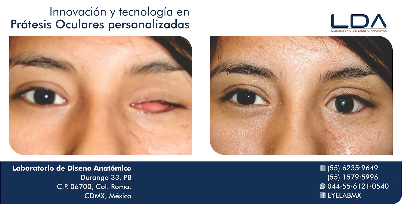 Antes y después de usar una prótesis ocular personalizada