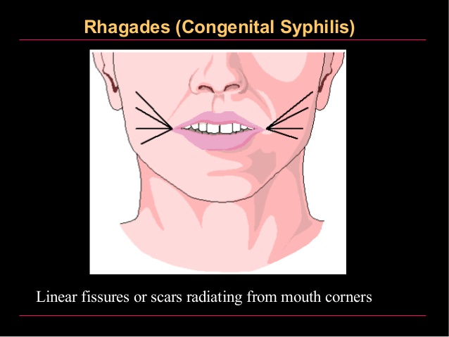 EXAMS AND ME : Rhagades