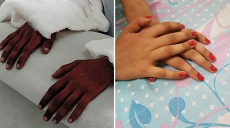 Male hands transplanted to a woman changed color and shape