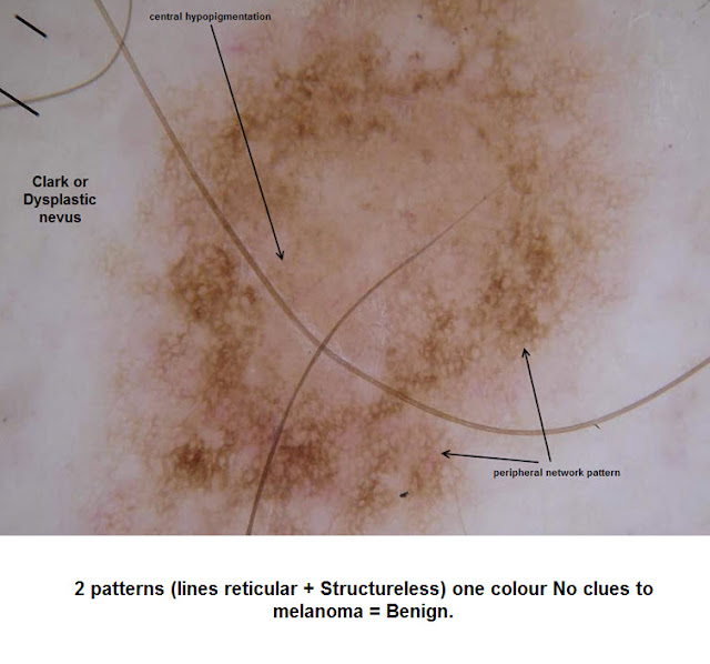 Dermoscopy Features as Clues: Lines Reticular