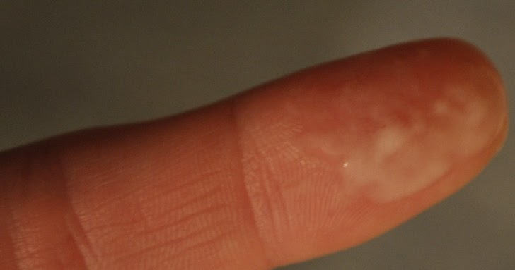 Leukorrhea - What is it and Should You Be Concerned? Find Out! - HEALTH ...