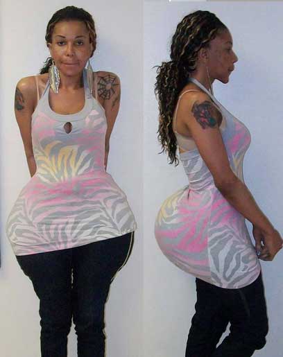 Brazilian Butt Lift – Buttock Augmentation Implants and Injections