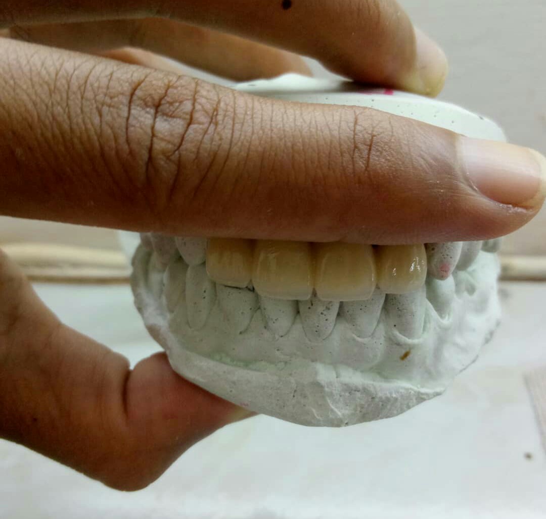 Mengenal Jenis Gigi Palsu Dan Perbedaannya.