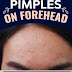 Forehead Acne: Causes, Treatment, And Prevention Tips - wellness days