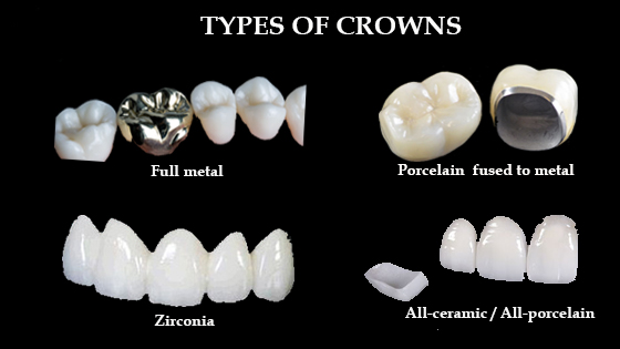 What Material Is A Dental Crown Made Up From? ~ Dr. Bharat Katarmal ...