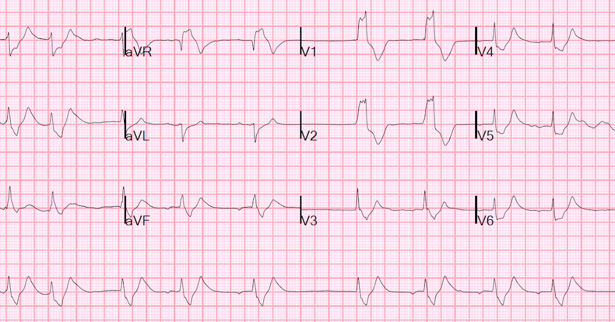 Dr. Smith's ECG Blog: A patient with cardiac arrest, ROSC, and right ...