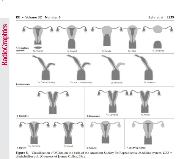Nagendra's Radiology Blog: MULLERIAN DUCT ABNORMALITIES