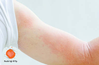 Hives (Urticaria) - All About It