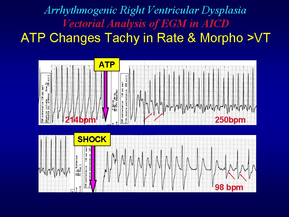 ARVCsGF: Vectorial interpretation of VT/SVT signals stored in the ICD