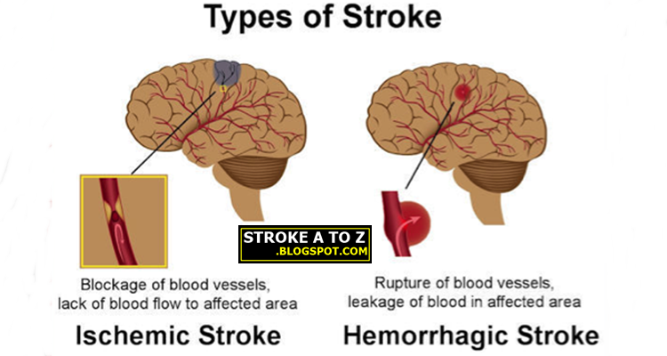 Diagnosis Stroke Hemoragik (Pendarahan) dan Stroke Iskemik