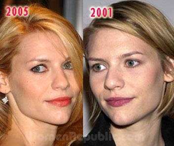 Claire Danes Plastic Surgery Before and After Nose Job, Botox ...