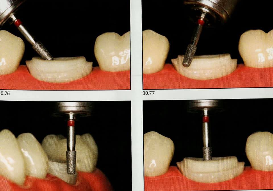Endocrown .. part 1 | Dental Esthetics
