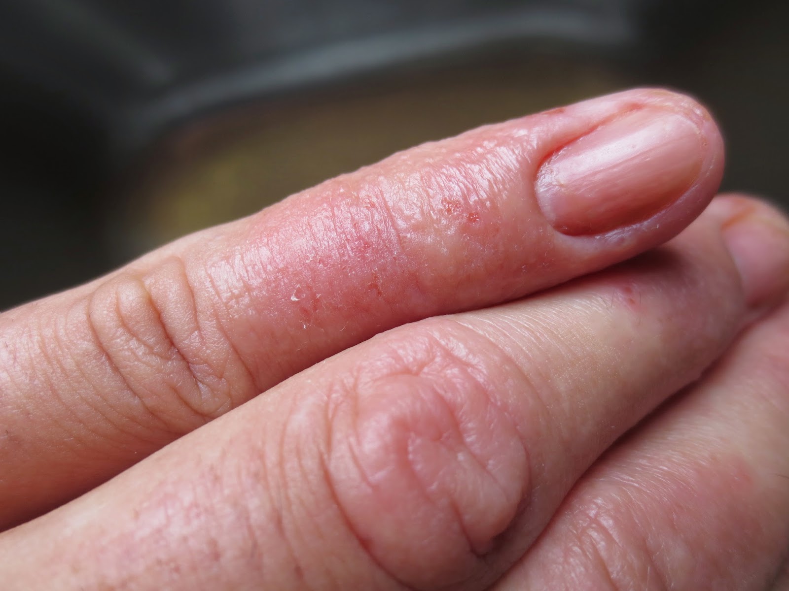SKIN DISEASE TYPES: Vesicular Hand Dermatitis (Skin Disease type)