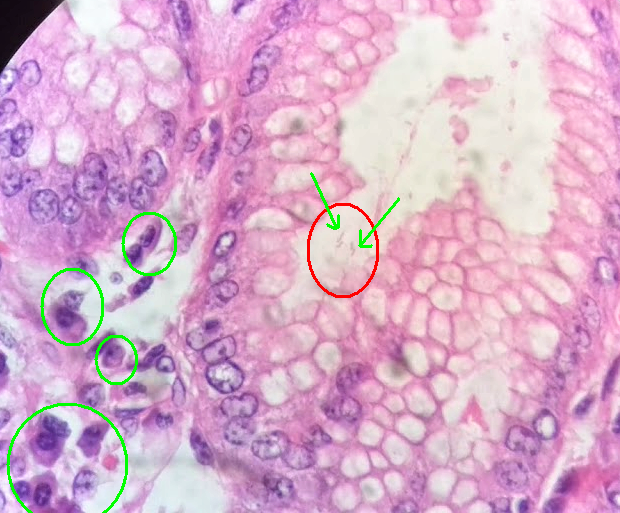 KIMAN - Making pathology simple!!: Helicobacter pylori - More than half ...