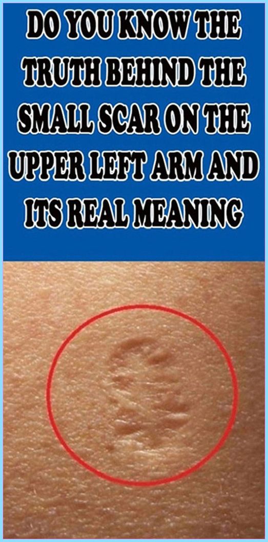 Do You Know The Truth Behind The Small Scar On The Upper Left Arm And ...