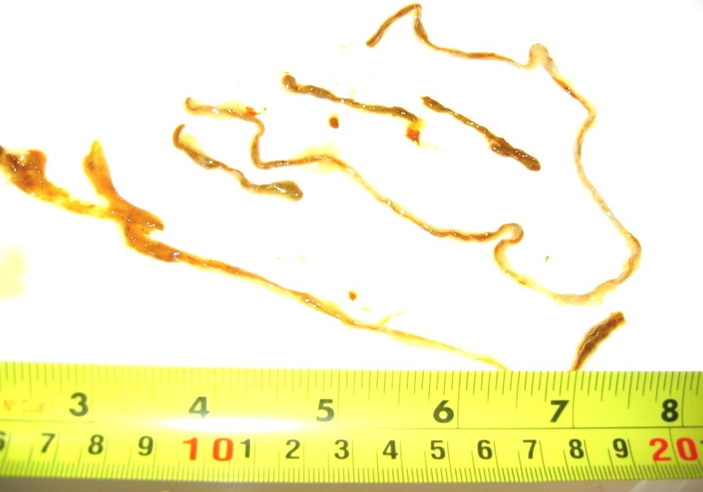Ascariasis - Human Roundworm Treatment