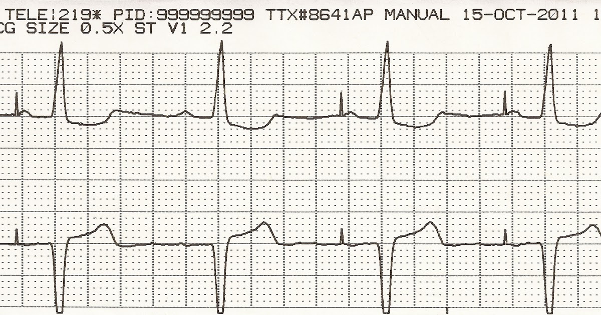 EKG Rhythm Strips 22: Paced Rhythms