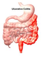 Colitis Ulcerativa, la más frecuente enfermedad inflamatoria intestinal