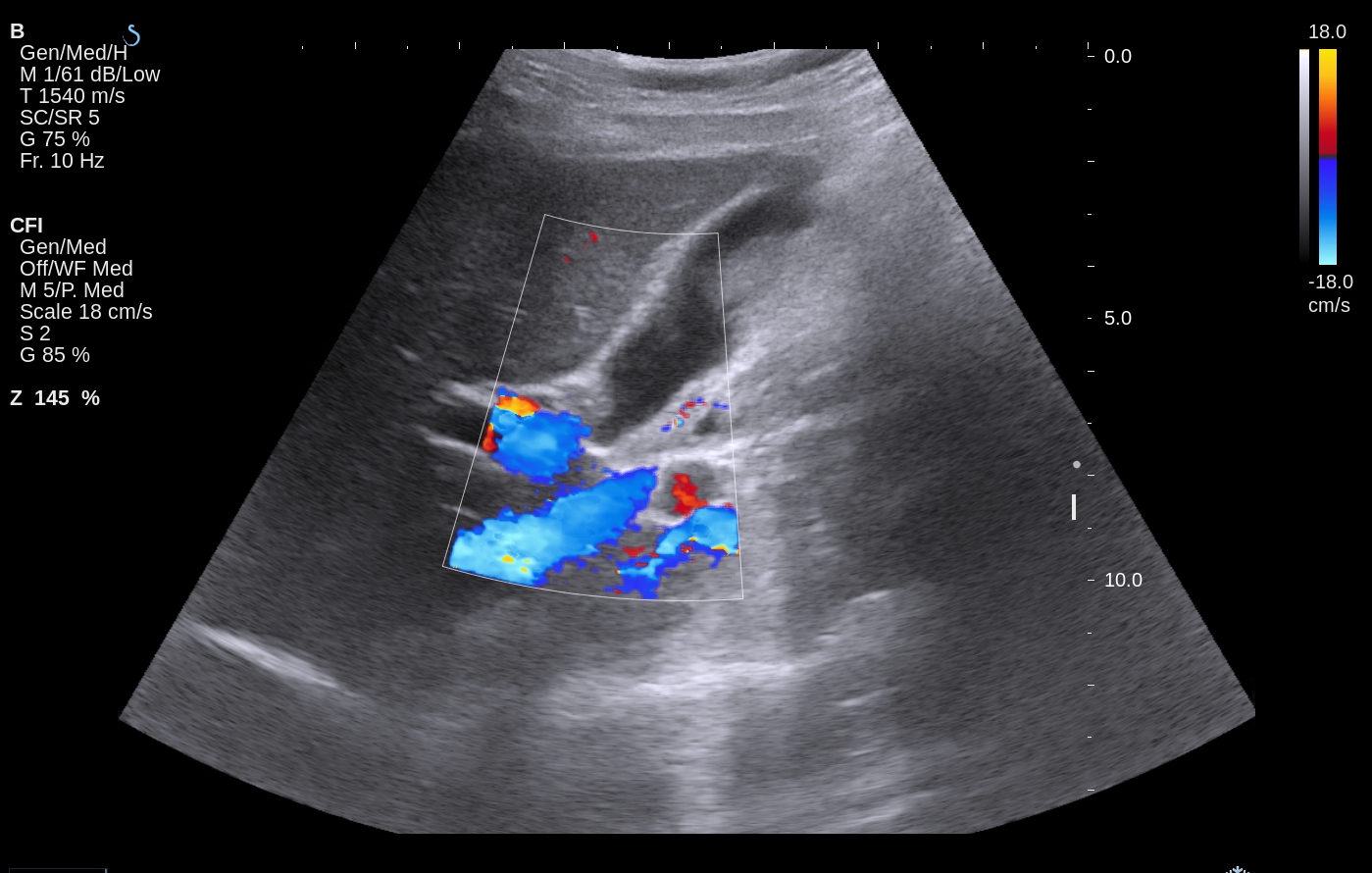 VIETNAMESE MEDIC ULTRASOUND: CASE 351:A CASE of FITZ-HUGH-CURTIS ...