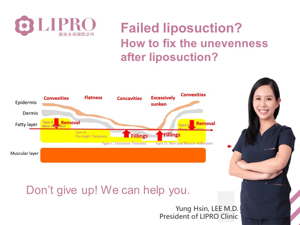LIPRO Microcannula Liposuction