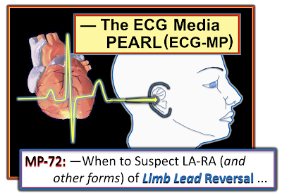 ECG Interpretation: ECG Blog #330 - Pneumonia with 2 ECG Findings!