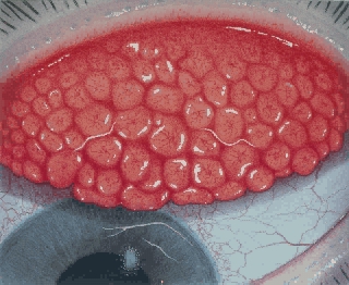 colour my life with colours: Papillary Conjunctivitis (eye checkup part1)