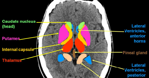 CT Scan Tips & Protocols: CT Brain anatomy