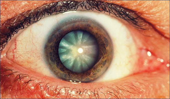 Cómo solucionar las carnosidades en los ojos - ¿Y cómo vas de salud?