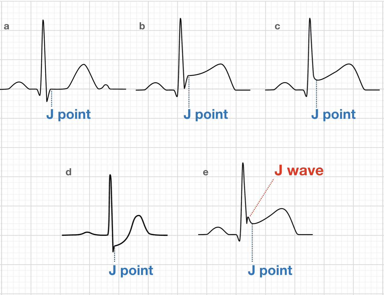 When To Tell Steminste Acslowintermediate Risk Acs By St Segment And T Wave In Ecg