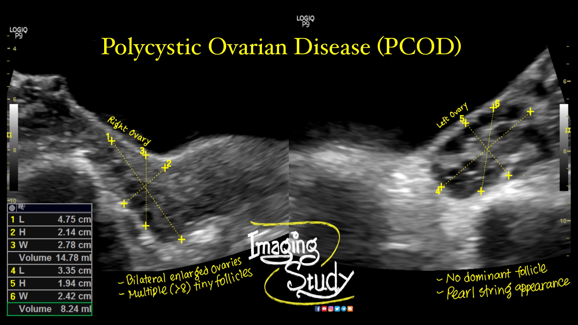 Imaging Study: Polycystic Ovarian Disease (PCOD)