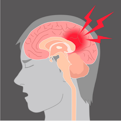 Brain and Spine Care Centre - Chennai: What Are Brain Lesions And How ...