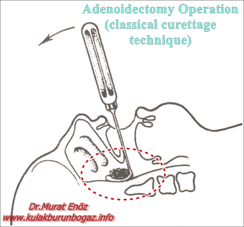 Adenoidectomy Operation in Istanbul