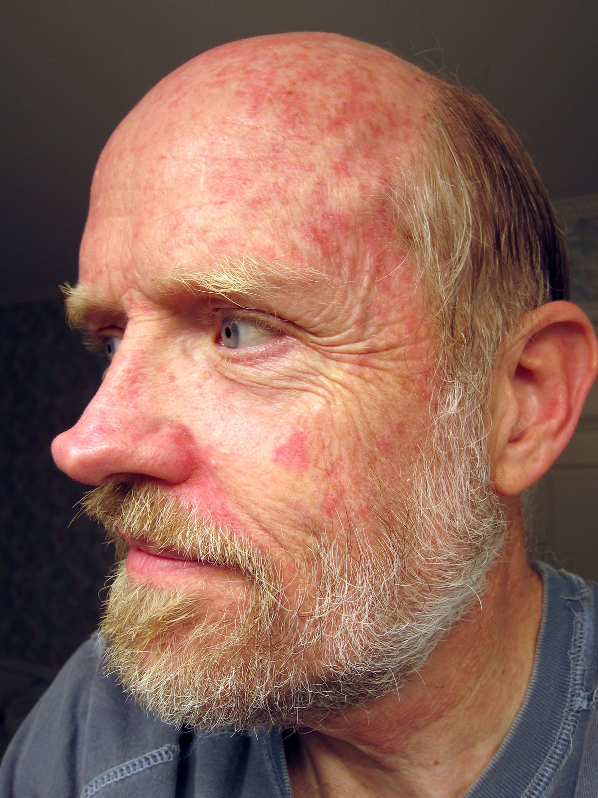 Efudex - Round Two: Day 9 - Starting to Feel the Burn