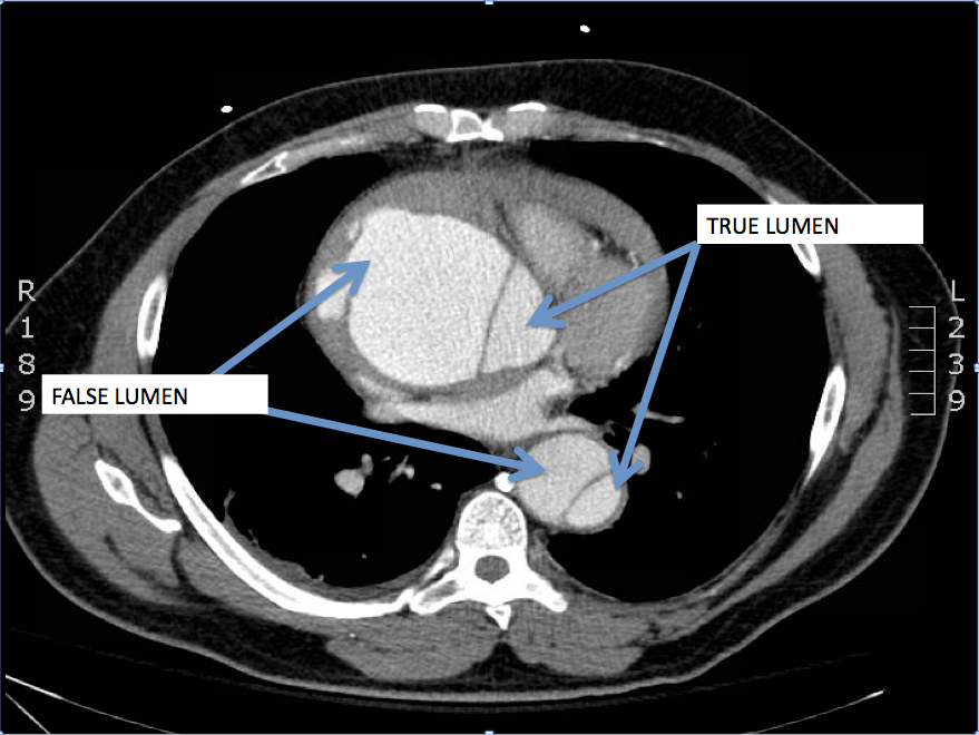 Emergency Medicine Visual Diagnosis: Diagnosis: Aortic Dissection