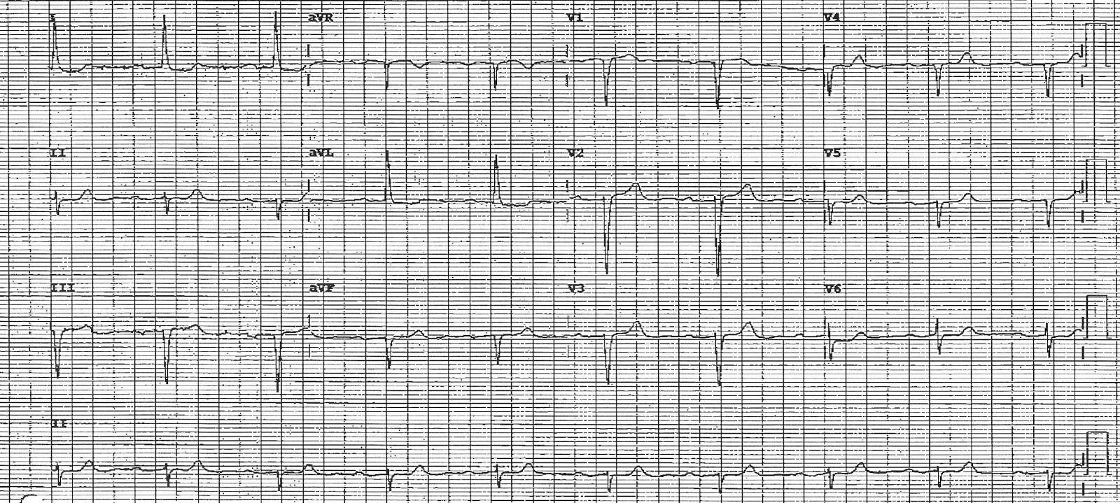 ECG of the Week: ECG of the Week - 13th February 2017 - Interpretation
