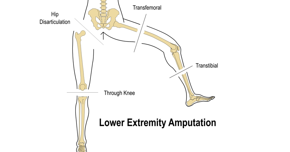 ICD 10 Coding Training: Amputations, Debridement and Spinal Fusion ...