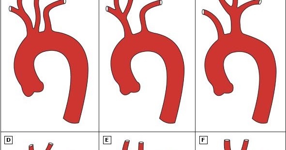 Vascular Mind : ANATOMICAL VARIANTS OF AORTIC ARCH BRANCHES / VARIANTES ...
